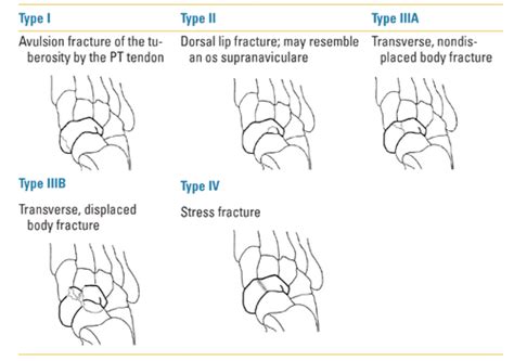 Navicular Fractures Flashcards Quizlet