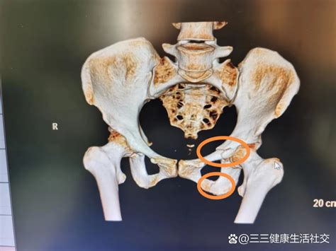 1️⃣左侧耻骨上下支、骶骨翼、骶骨骨折第3天