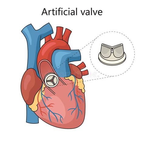 Artificial Heart Valve In Heart Medical Science Stock Vector Illustration Of Medicine Scheme