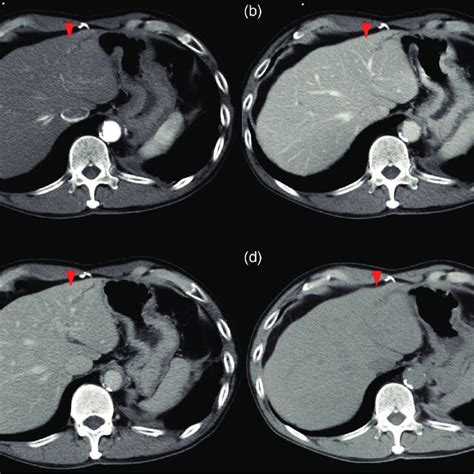 Anatomic Lateral Segmentectomy And S8 Segmentectomy White Arrow Head