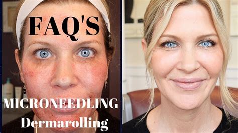 How Often Should You Microneedle Captions Hangout
