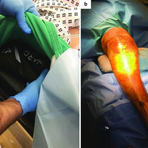 5 A Supine Position With Sandbag Under Ipsilateral Buttock B