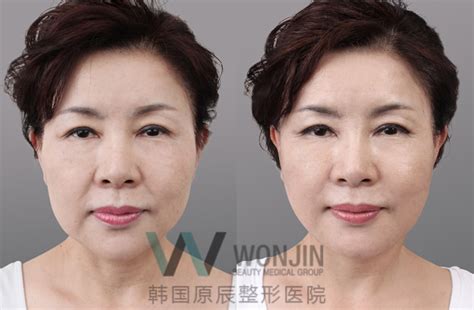 抗衰老案例 抗衰老对比图 韩国原辰医院抗衰老案例 我的网站
