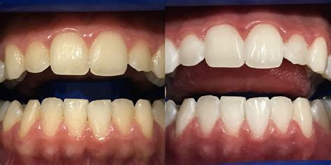 Dental Bleaching Dental Office By Dr Peiter