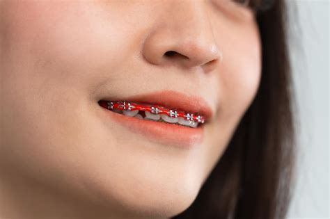 Premium Photo Asian Woman Braces Teeth Braces On The White Teeth Of