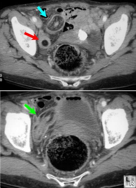 Intussusception X Ray