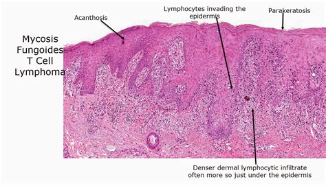 Dermatopathology Made Simple Inflammatory Psoriasiform Reaction Pattern