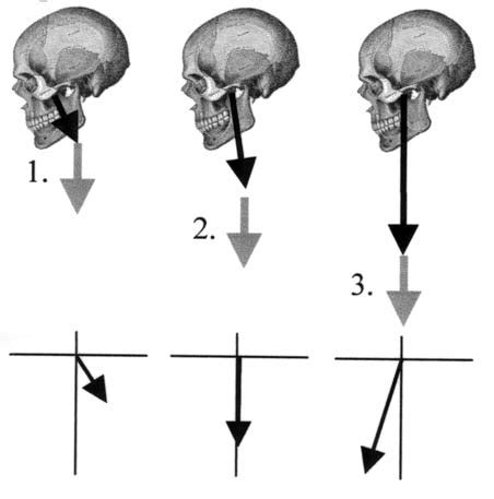 Diagrams 1 2 And 3 Show A Progression Of The Vector Of Pull On The