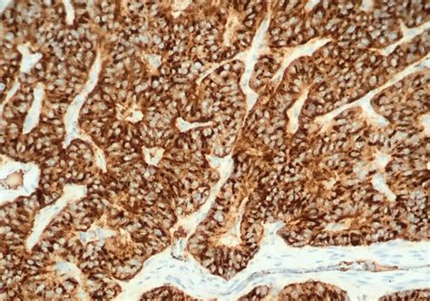 Positive Staining For Chromogranin A And Synaptophysin Download Scientific Diagram