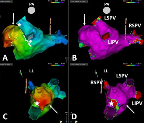 The 3d Activation A And C And Voltage B And D Maps 0205 Mv Of Download Scientific