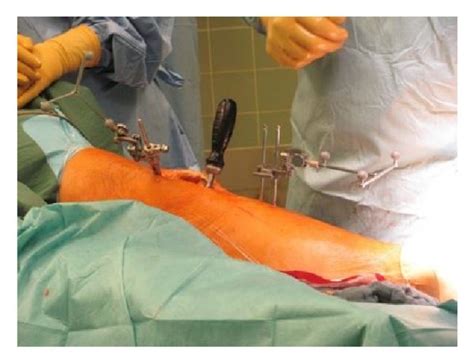 A Attachment Of Reference Arrays B Digitalisation Of Anatomical Download Scientific