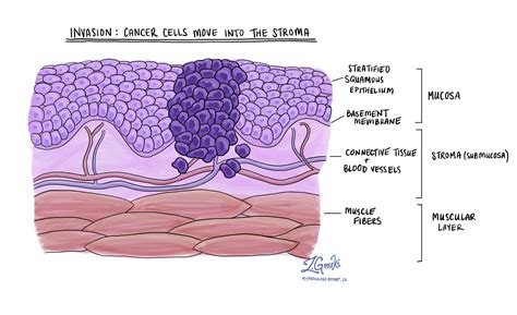Squamous Cell Carcinoma Of The Oral Cavity Mypathologyreport