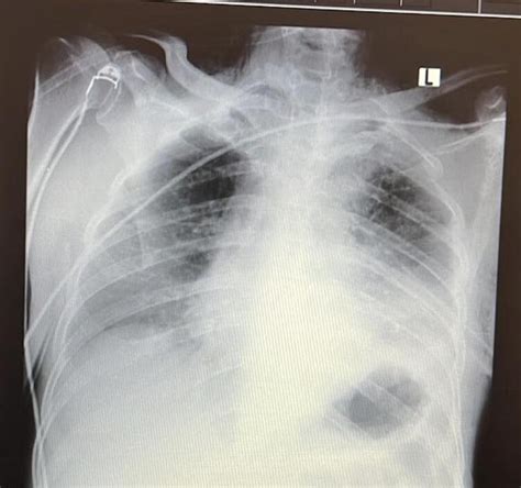A Case Report On Chylothorax Post Penetrating Chest Trauma Pmc