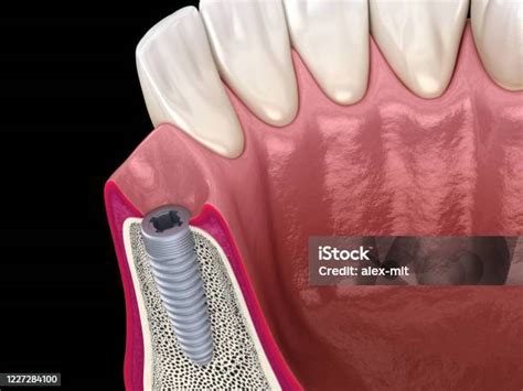 치과 이식 의학적으로 정확한 치아 3d 그림 건강관리와 의술에 대한 스톡 사진 및 기타 이미지 건강관리와 의술 단면도 디지털 생성 이미지 Istock