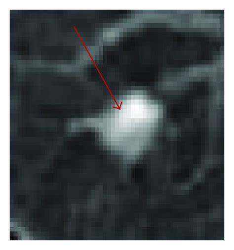 All Kinds Of Pulmonary Nodules A Vascular Adhesion B Pleural