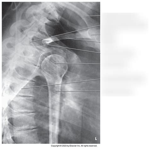 Transthoracic Lateral Shoulder Diagram Quizlet