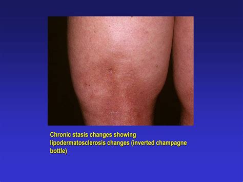 Ppt Venous Stasis Dermatitis Powerpoint Presentation Free Download