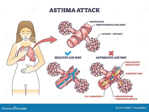 Asthma Attack Diagram Role Of The Nlrp3 Inflammasome In Asthma