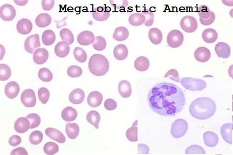 Macrocytic Anemia Megaloblastic Anemia