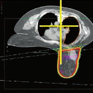 Pendulous Breast In Supine Position Without Microshell Immobilization