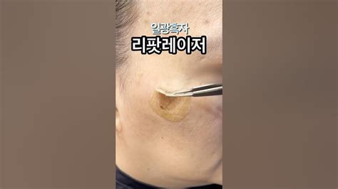 흑자는 방치할 수록 커져요 일산흑자 일산리팟 일산피부과 흑자제거 김포흑자 부천흑자 덕양구피부과 파주흑자 운정리팟 리팟레이저 흑자 Youtube
