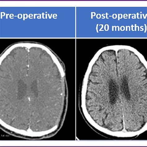 The Calvarial Defect Was Observed To Be Filled Completely 8 Months Download Scientific Diagram