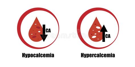 Hypocalcemia And Hypercalcemia Vector Round Iicon Stock Vector Illustration Of Comparison