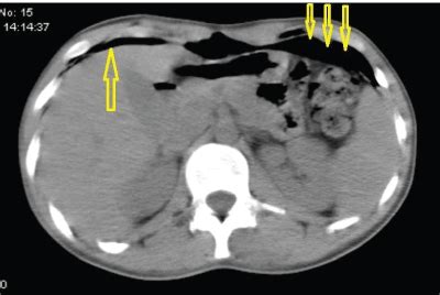 Is Intraabdominal Air Detected On Ct Scan Always Indicative Of
