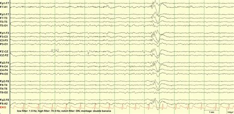 Eeg Spikes