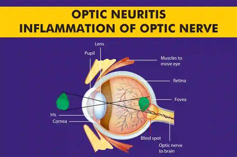 Optic Neuritis Causes Symptoms Diagnosis And Treatment