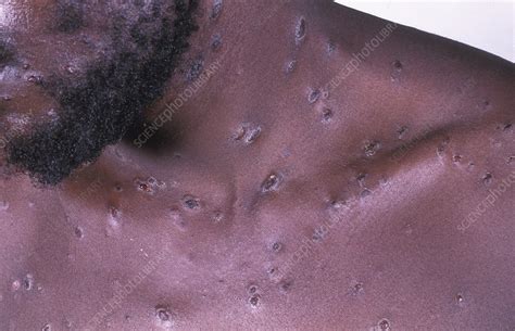 Syphilis Skin Lesions Stock Image M8620070 Science Photo Library