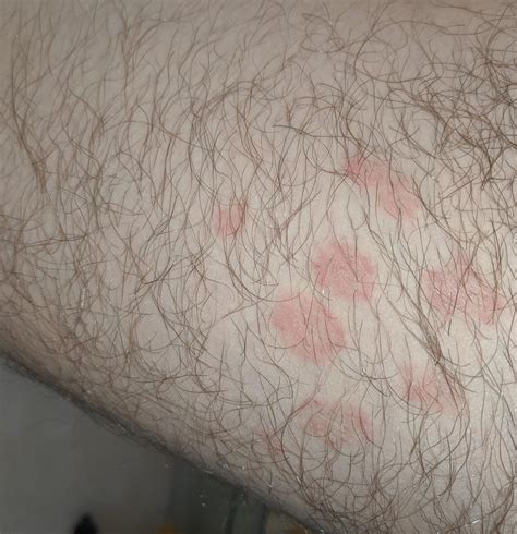 Weird Red Marks On Inner Thigh Close To Groin Region Noticed Two Days Ago Rdiagnoseme