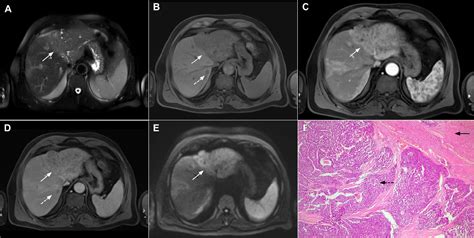 Figure 1 From Imaging Spectrum Of Intrahepatic Mass Forming Cholangiocarcinoma And Its Mimickers