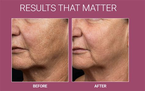 Boulder Valley Center For Dermatology Fraxel Dual Laser Treatment