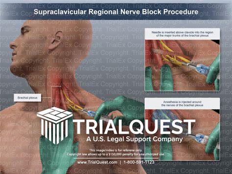 Supraclavicular Regional Nerve Block Procedure Trialquest Inc