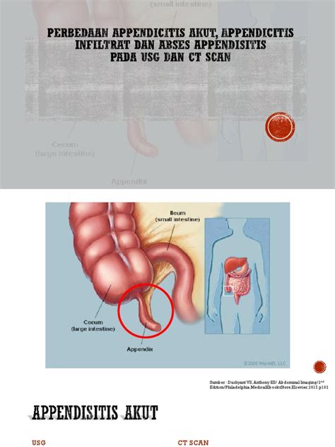 Slide Perbedaan Appendicitis Akut Appendicitis Infiltrat Dan Abses Pdf Ct Scan Medicine