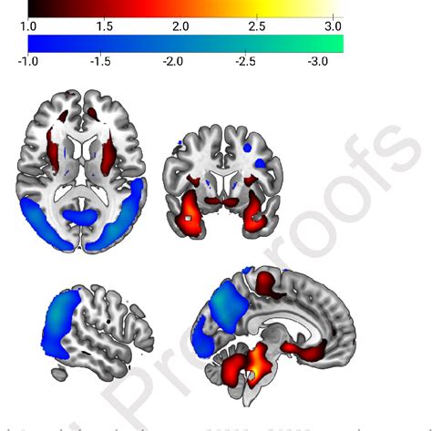 Table 1 From Metabolic Brain Pattern In Dementia With Lewy Bodies