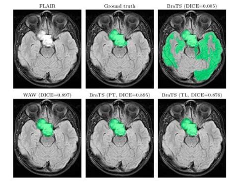Segmenting Pediatric Optic Pathway Glioma From Mri Using Deep Learning