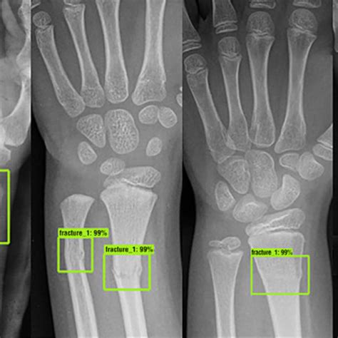 Bone Fracture Detection Computer Vision Project Kaggle