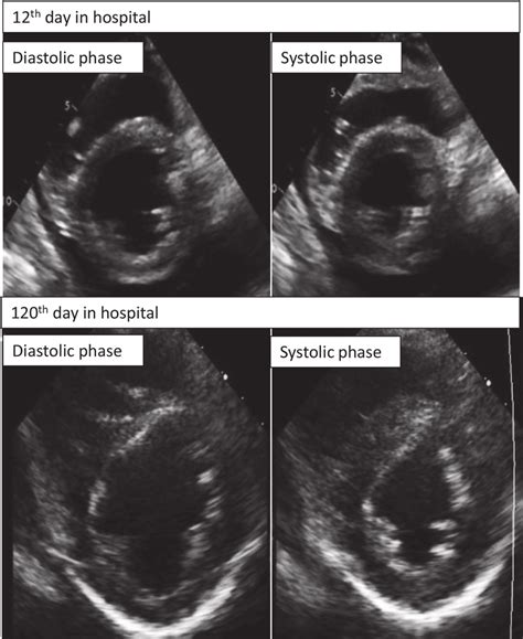 Clinical Course Of Cardiomyopathy Echocardiogram Mild Diffuse Download Scientific Diagram Clinical Course Of Cardiomyopathy Echocardiogram Mild Diffuse Download Scientific Diagram