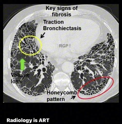 Types Of Bronchiectasis Youtube