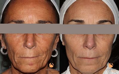 Ematrix Before And After Pictures Realself