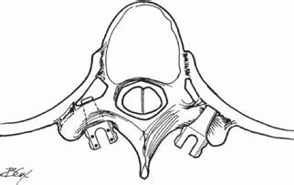 Supralaminar Infralaminar Transverse Process Hook Placement Neupsy Key