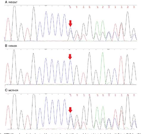 Figure 3 From A Patient With Pseudohypoparathyroidism Type 1a Previously Misdiagnosed As