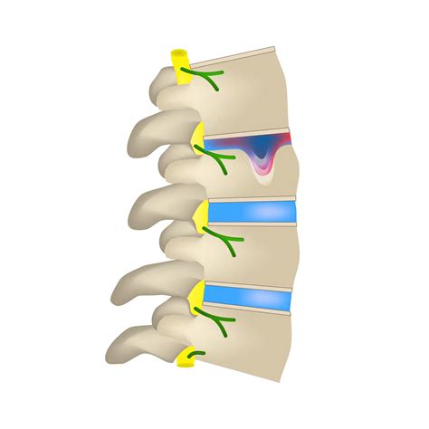 Schmorls Nodes Definition Causes Symptoms And Treatment Spine Info