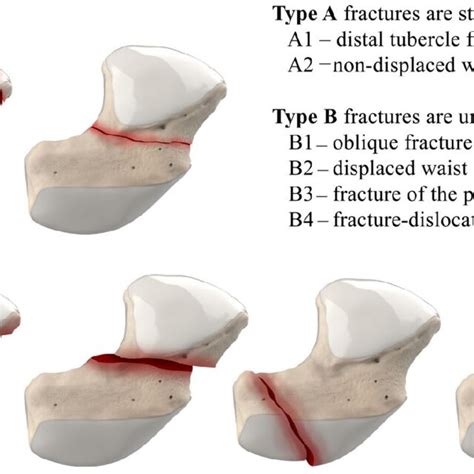 Herbert Classification Of Scaphoid Fractures Type A Fractures Are