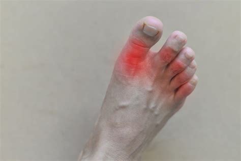 Can Gout Affect Sexual Health And Performance Mens Health Clinic