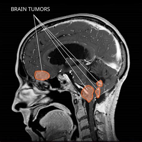 Choroid Plexus Tumors National Cancer Institute