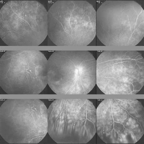 Macular Involvement And Midperipheral Fundus Telangiectatic Retinal