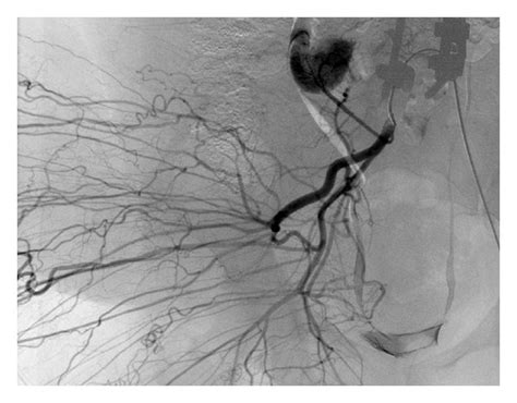 Selective Catheterization Is Performed To Do A Selective Embolization Download Scientific